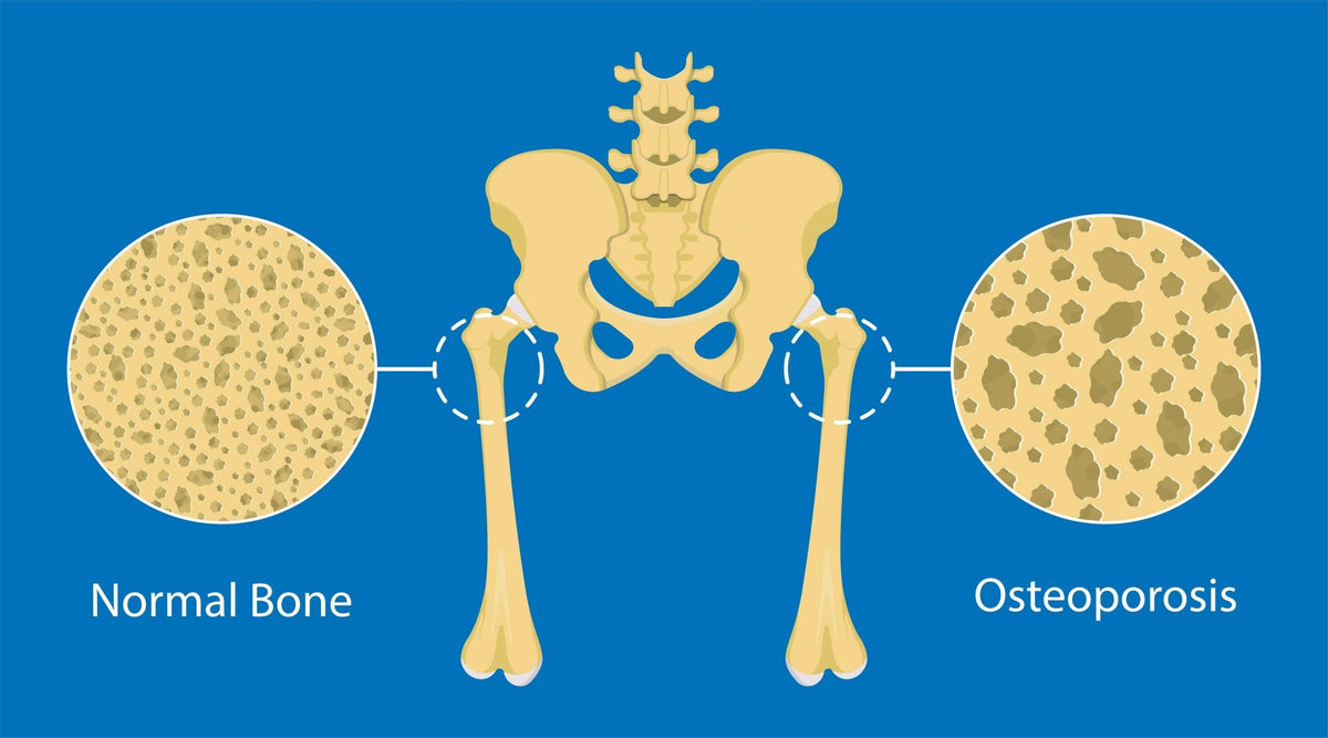 Tymlos vs. Forteo: A Comparison Between 2 Osteoporosis Injections