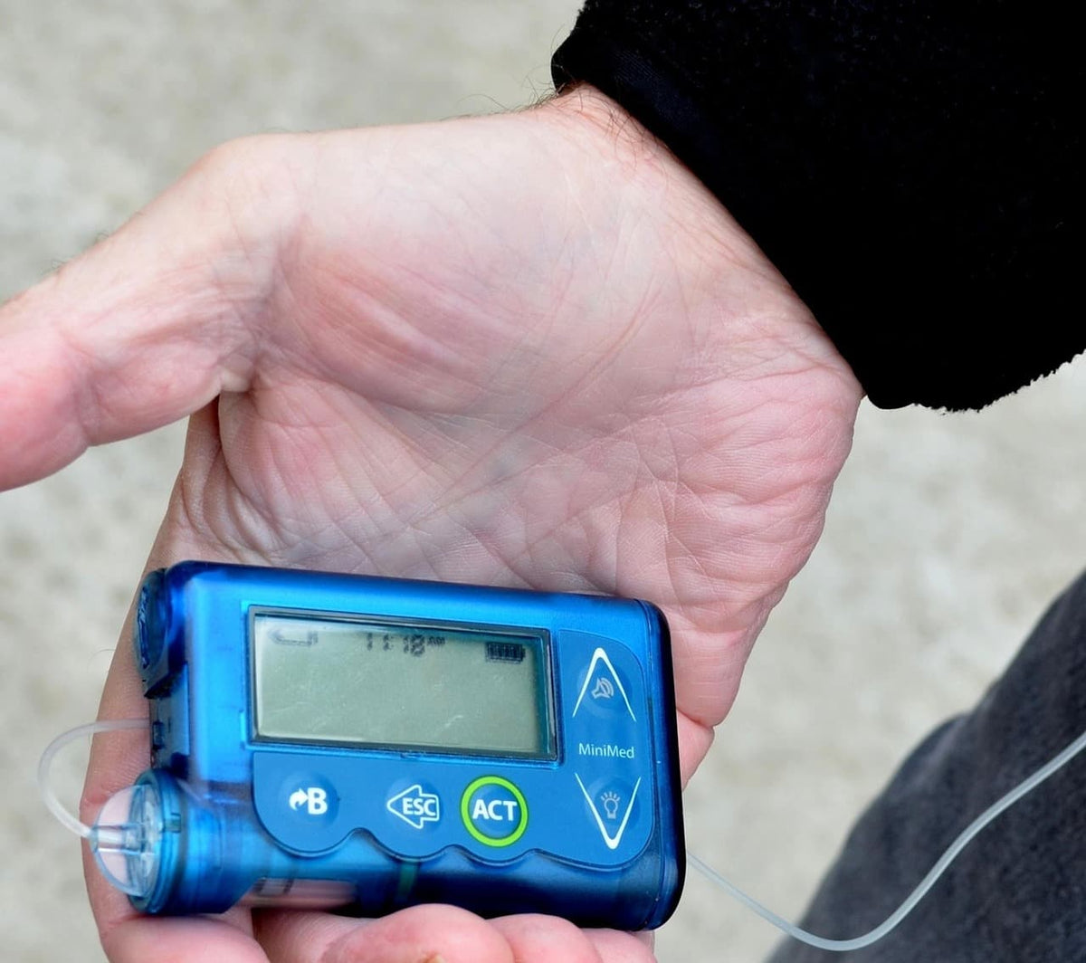Scar Tissue at Insulin Pump Sites: Causes & Prevention